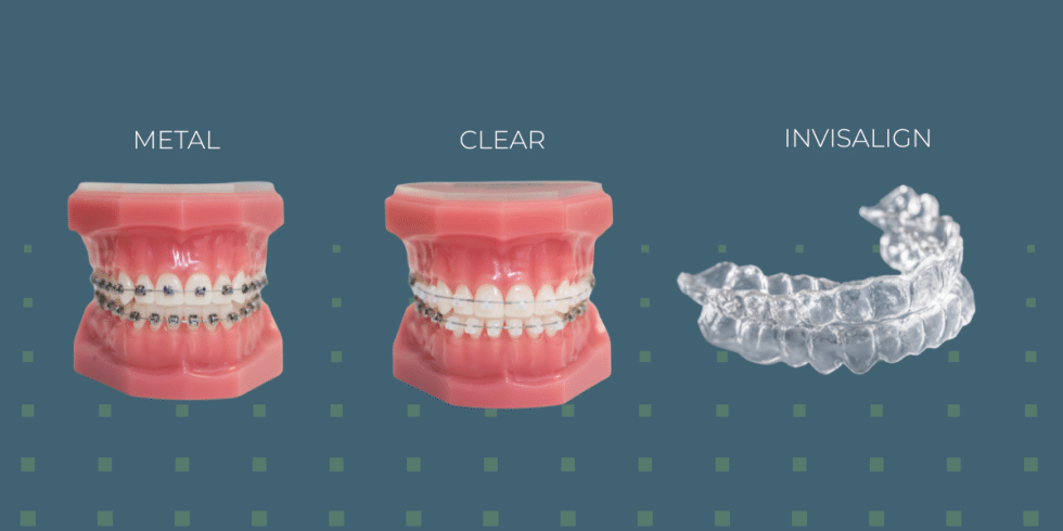 Cost of Braces in Boca Raton | Parkland Orthodontics