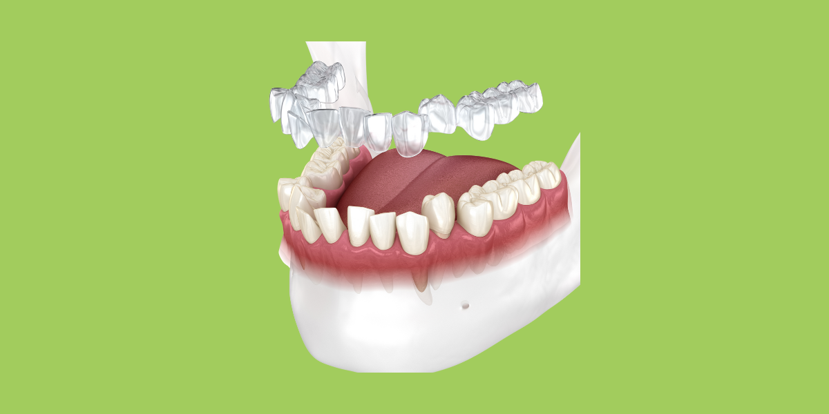 Invisalign Clear Aligners in Boca Raton | Parkland Orthodontics